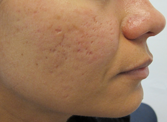 Galleri – Acne Specialisten